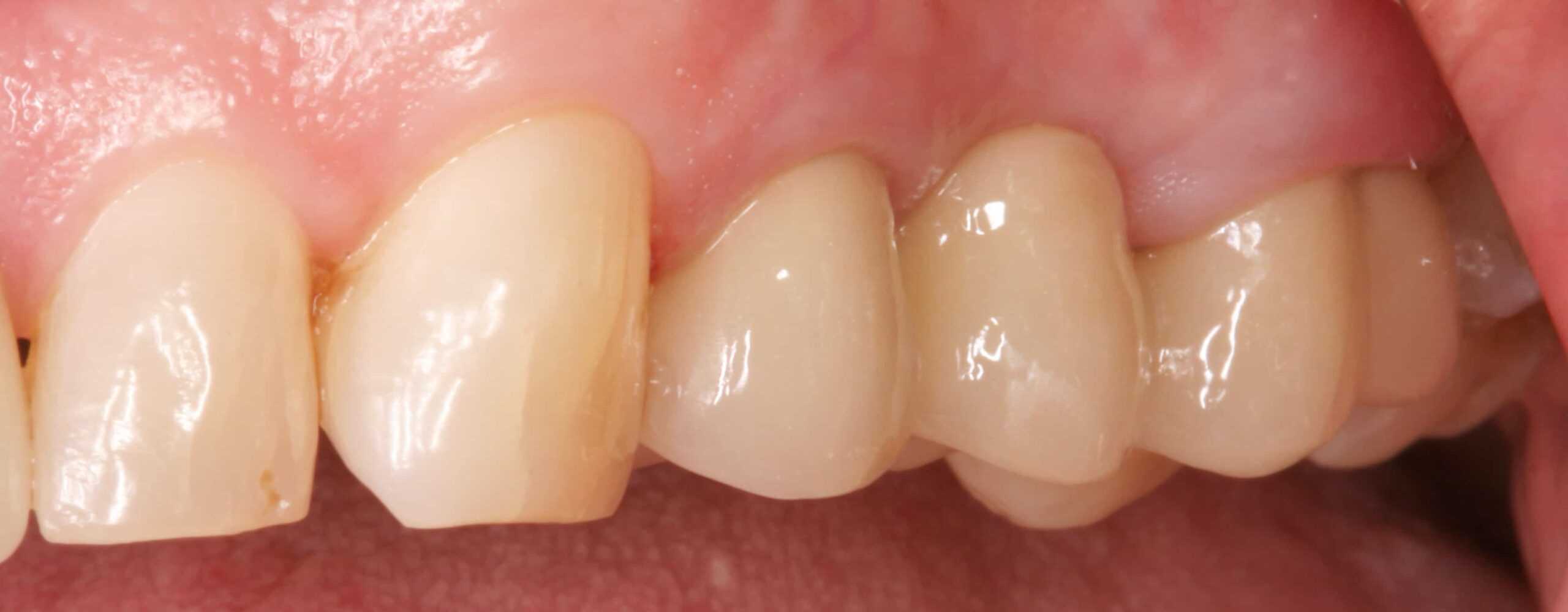 Case Study - Dental Bridge