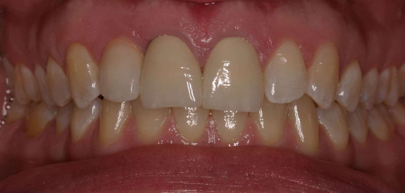Partial Tooth Replacement | DenteVita Prosthodontics