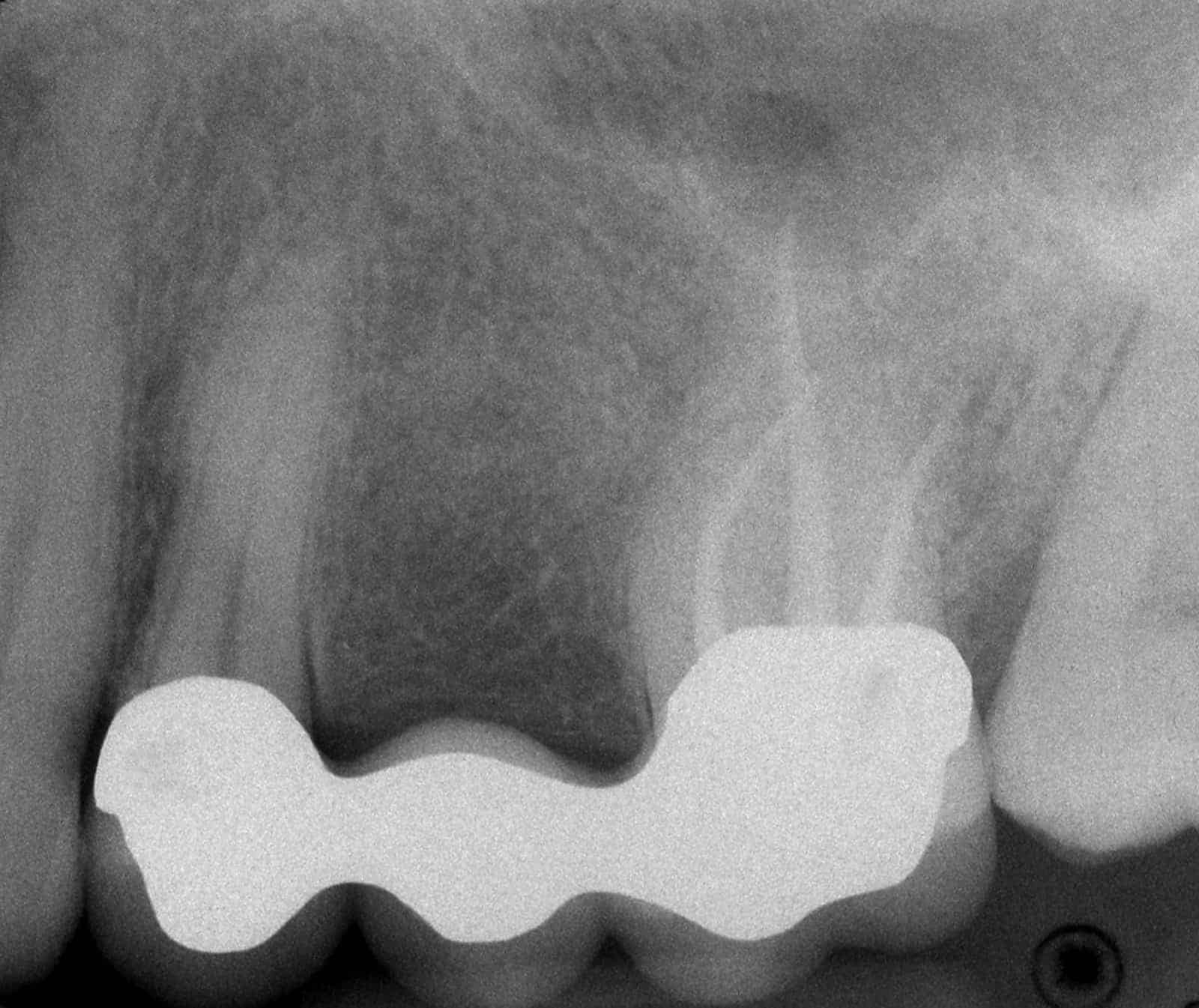 Case Study - Dental Bridge