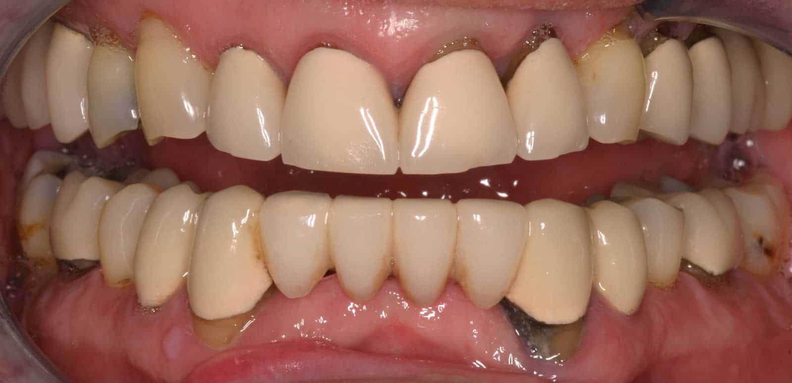 Case Study - Tooth Rehabilitation