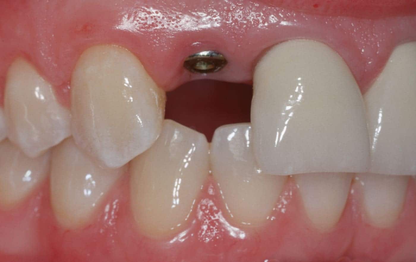 Partial Tooth Replacement | DenteVita Prosthodontics