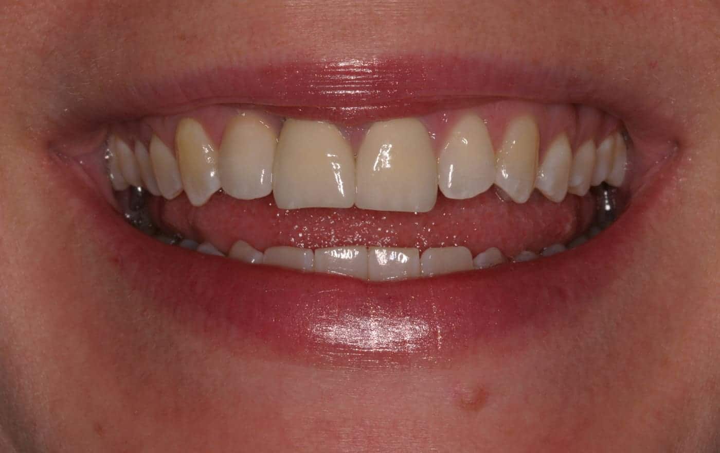 Partial Tooth Replacement | DenteVita Prosthodontics
