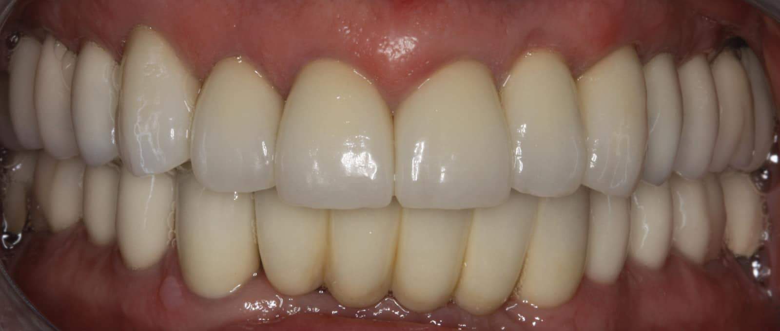 Case Study - Tooth Rehabilitation